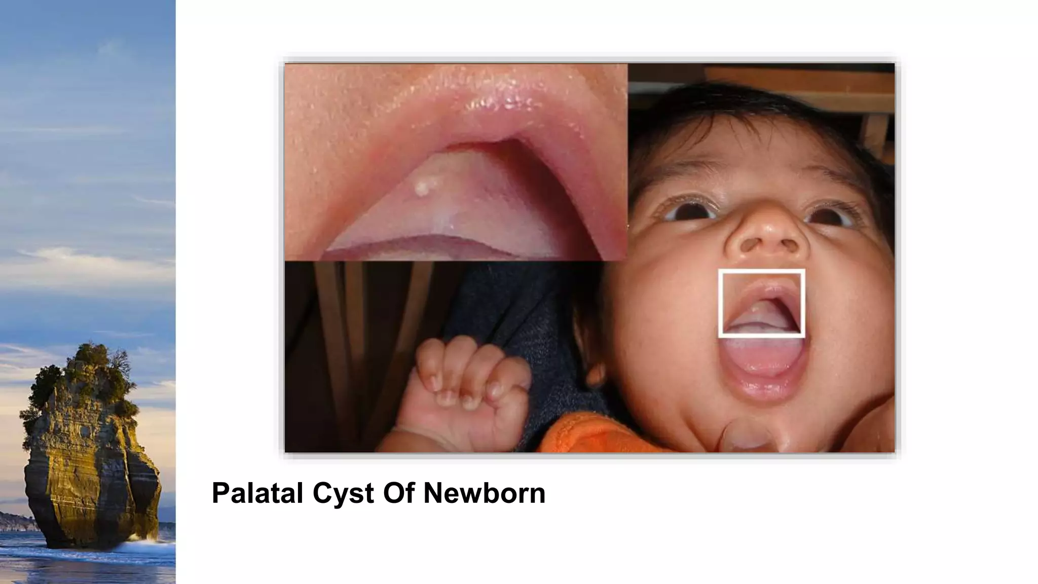 Cutaneous Cysts | PPTX