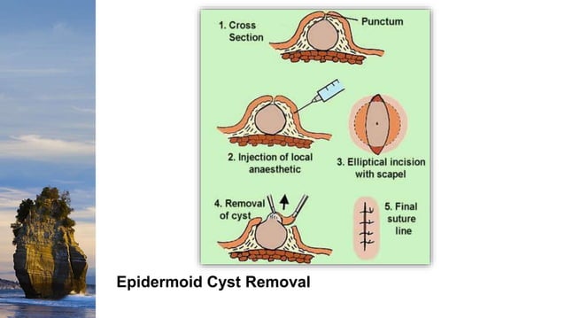 Cutaneous Cysts | PPTX | Skin and Dermatology | Diseases and Conditions