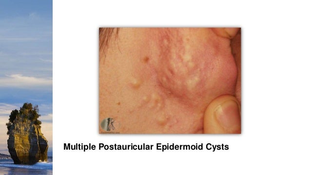 Epidermoid Cyst Wikidoc