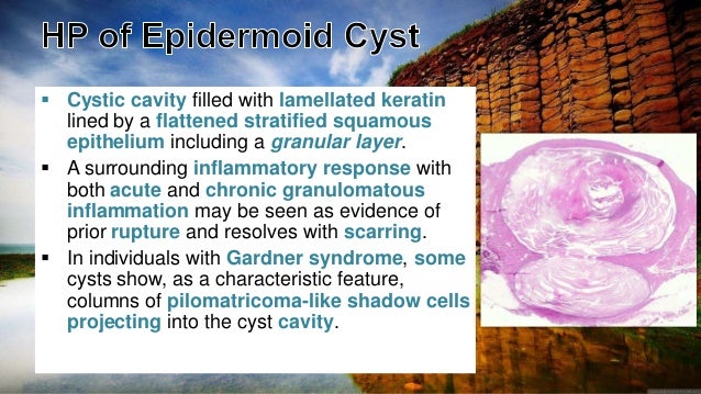 Epidermoid Cysts Scrotum