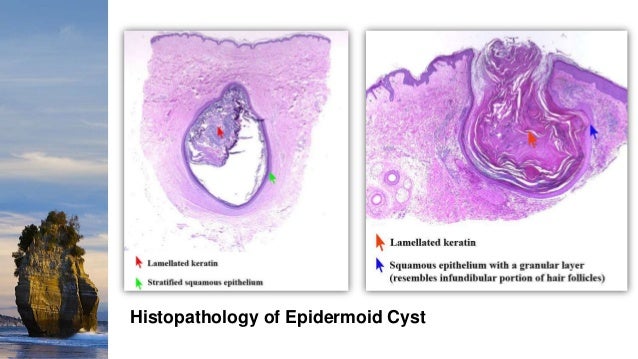Cutaneous Cysts