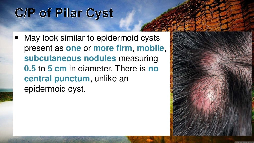 Cutaneous Cysts