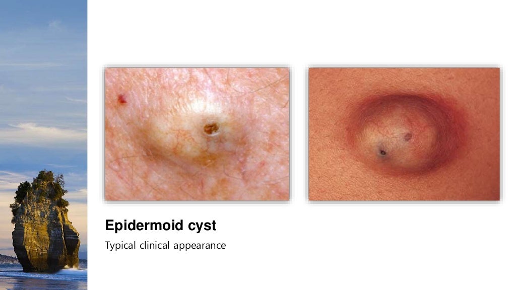 Cutaneous Cysts cutaneous-cysts