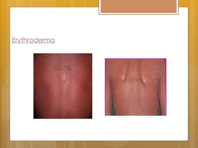 Cutaneous Drug eruptions (part-2).pptxcc | PPT