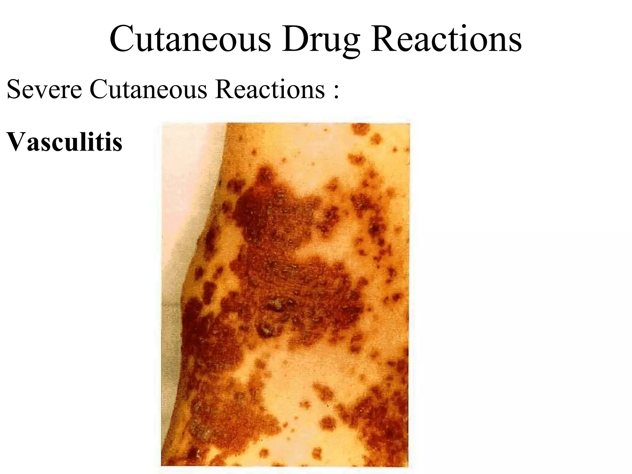 Cutaneous drug reactions | PDF