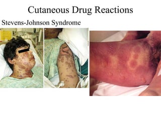 Cutaneous drug reactions | PDF