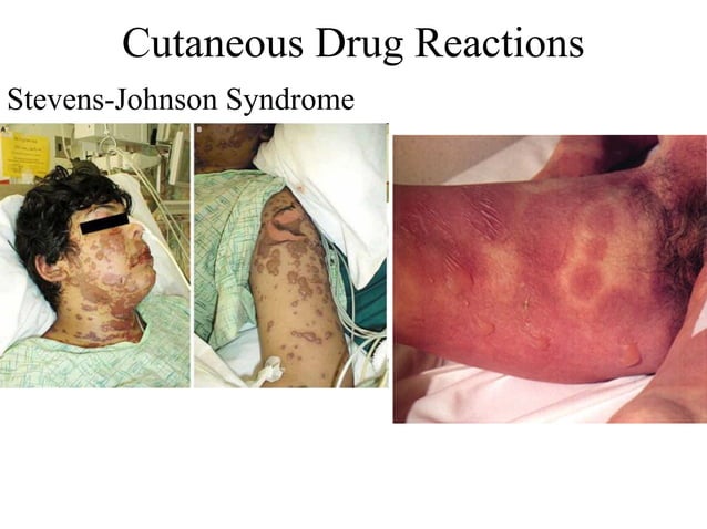 Cutaneous drug reactions | PDF | Skin and Dermatology | Diseases and ...