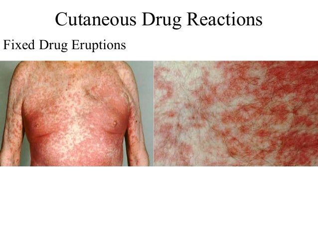 Cutaneous drug reactions