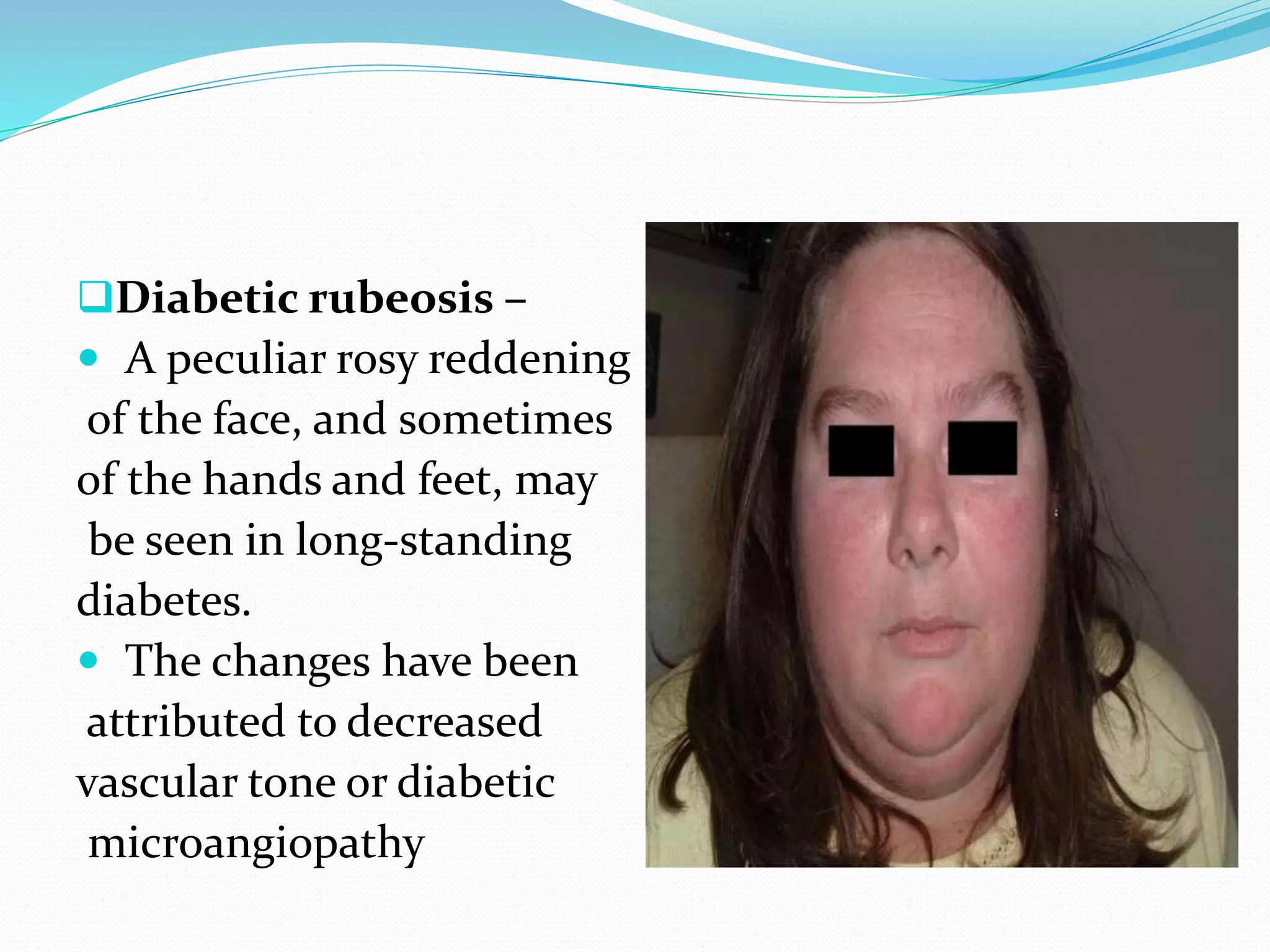 Cutaneous features of endocrine diseases | PPTX | Foot Health ...