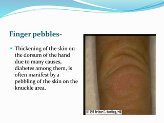 Cutaneous features of endocrine diseases | PPTX