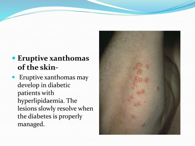 Cutaneous features of endocrine diseases | PPTX | Foot Health ...