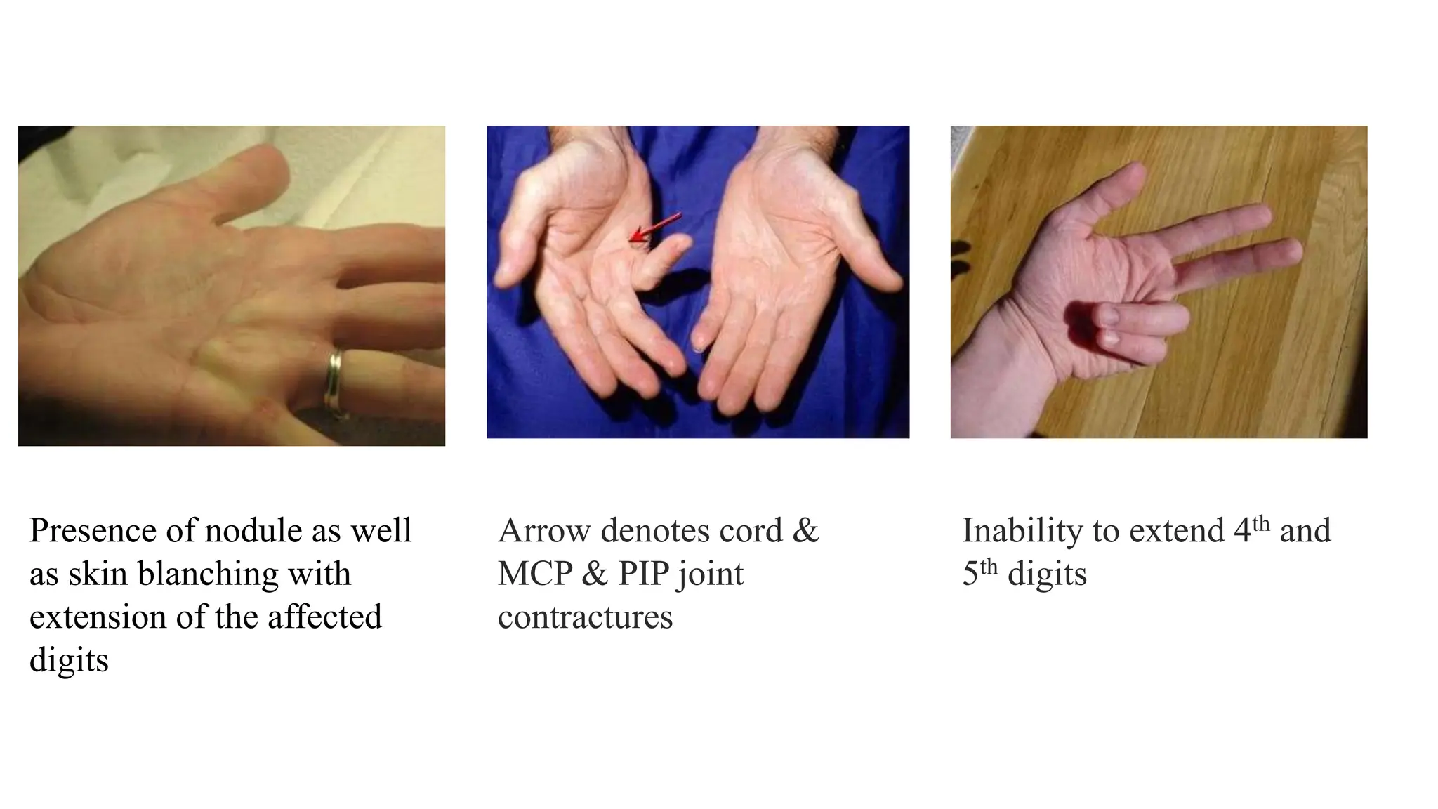 Cutaneous fibromatosis.pptx (Clinical, Histopathological and Treatment ...
