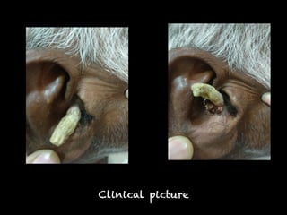 Cutaneous horn of pinna | PPT