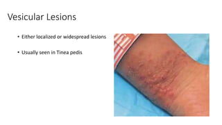 Cutaneous id reaction derma ppt dermatophytosis | PPTX