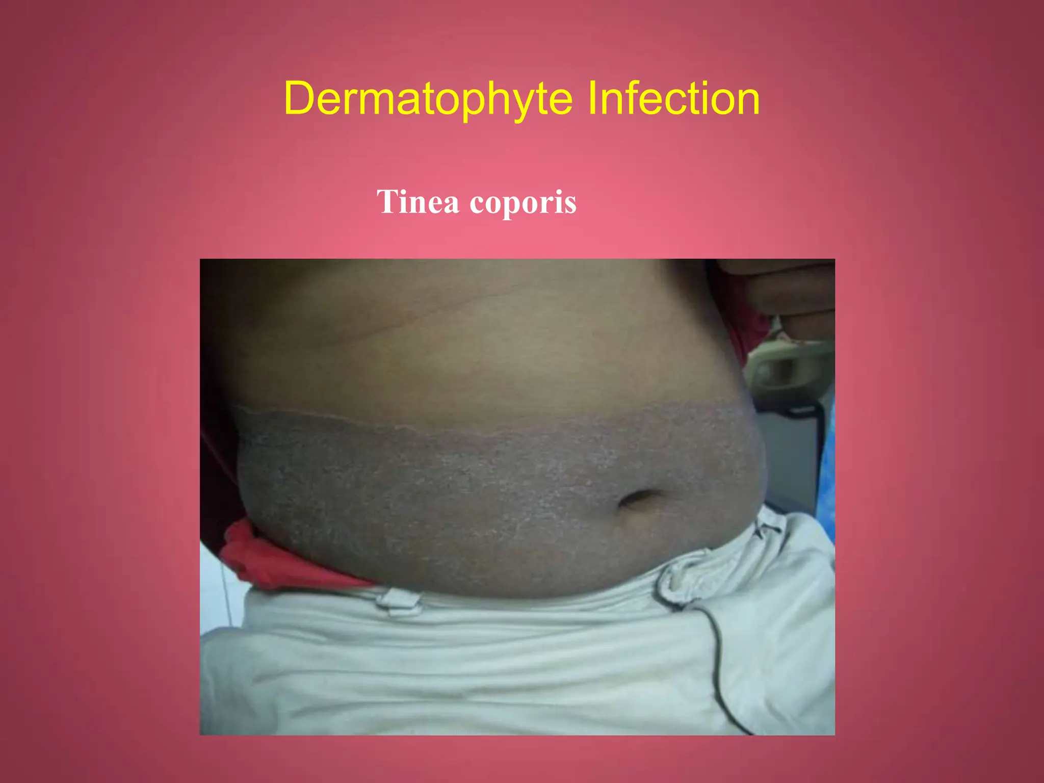 Cutaneous Infections of skin disease management | PPT