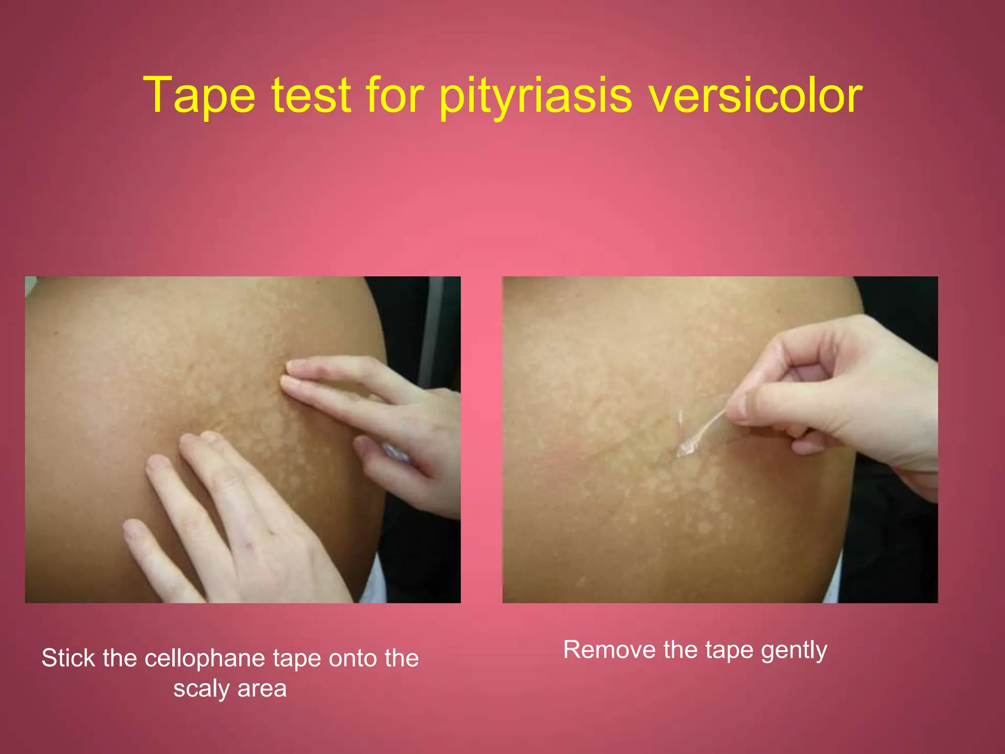 Cutaneous Infections of skin disease management | PPT