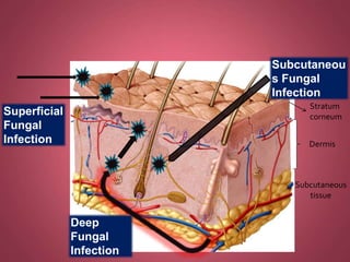 Cutaneous Infections of skin disease management | PPT
