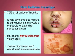 Cutaneous Infections of skin disease management | PPT