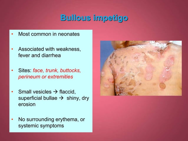 Cutaneous Infections of skin disease management | PPT