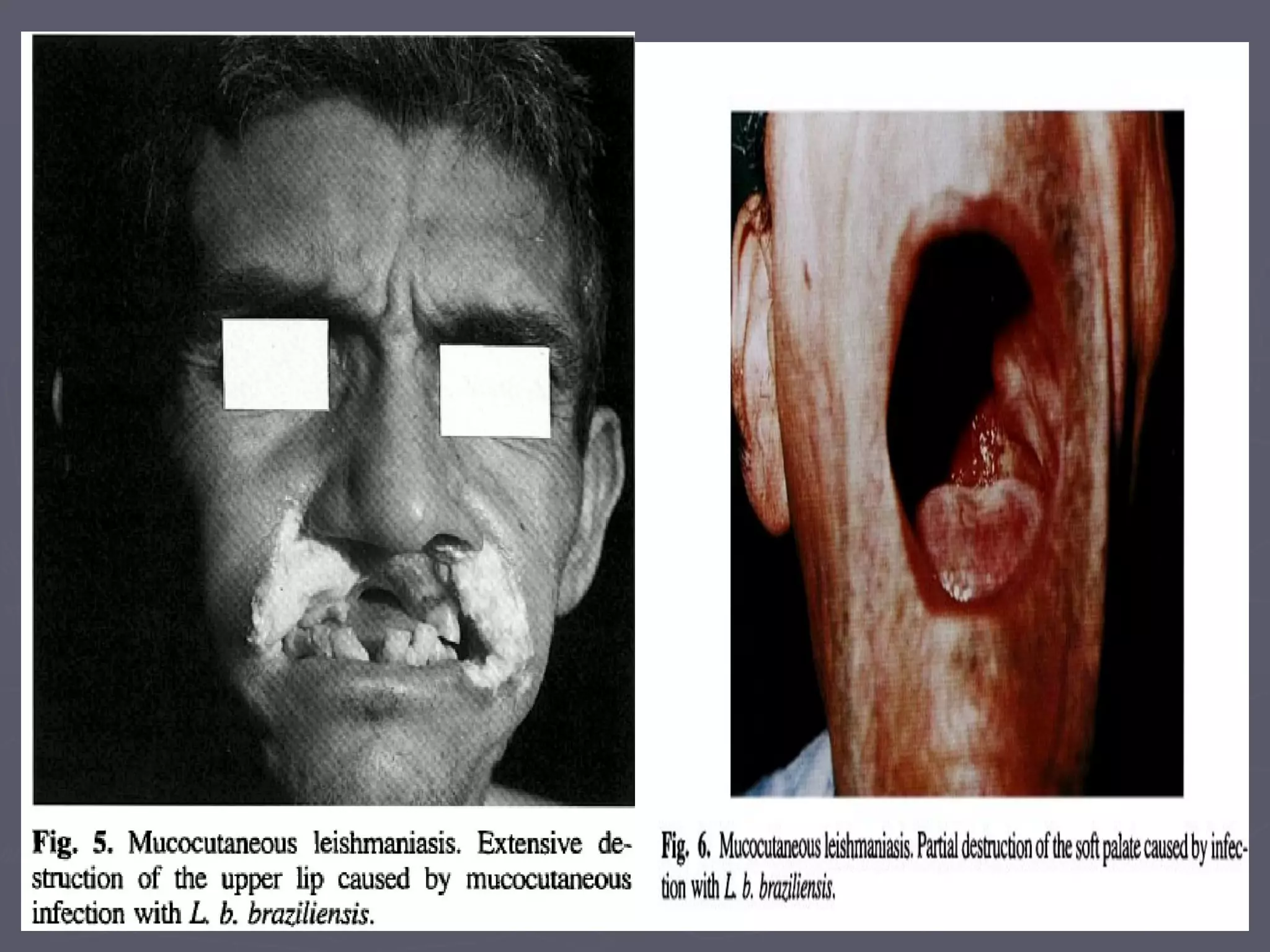 Cutaneous leishmaniasis clinical spectrum management | PPT
