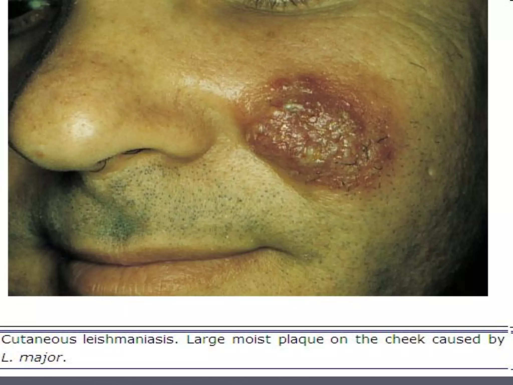 Cutaneous leishmaniasis clinical spectrum management | PPT
