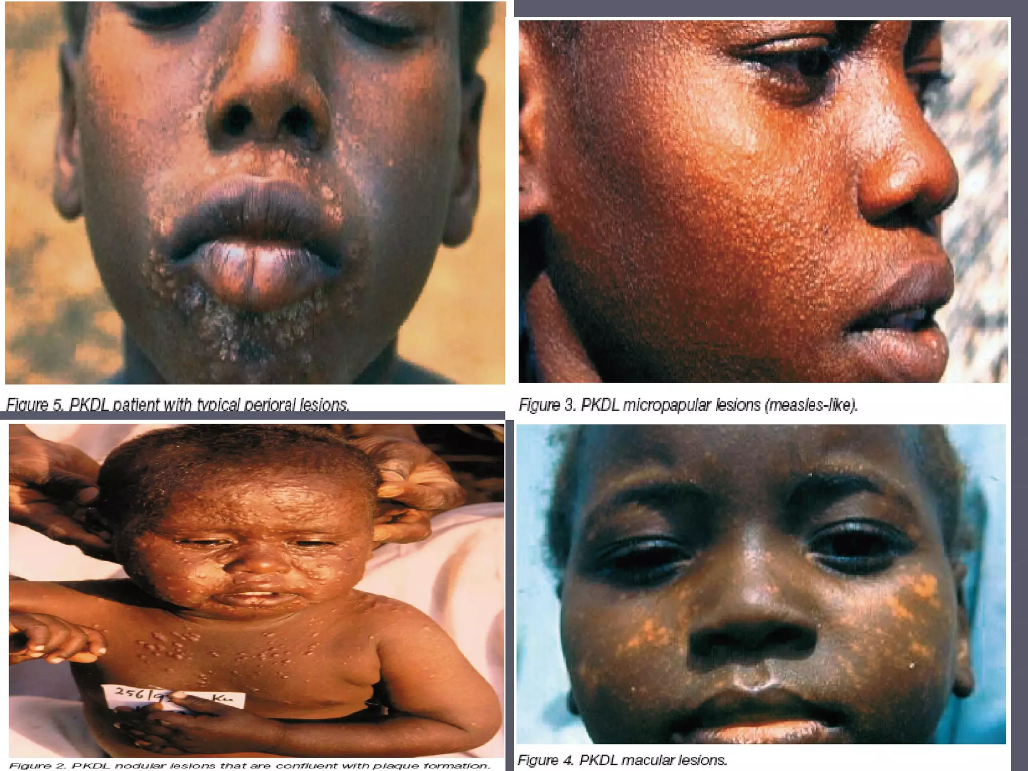 Cutaneous leishmaniasis clinical spectrum management | PPT