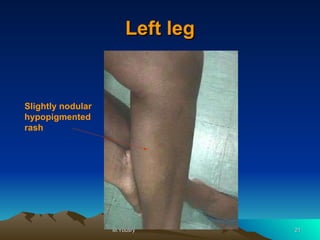 Cutaneous Leprosy | PPS