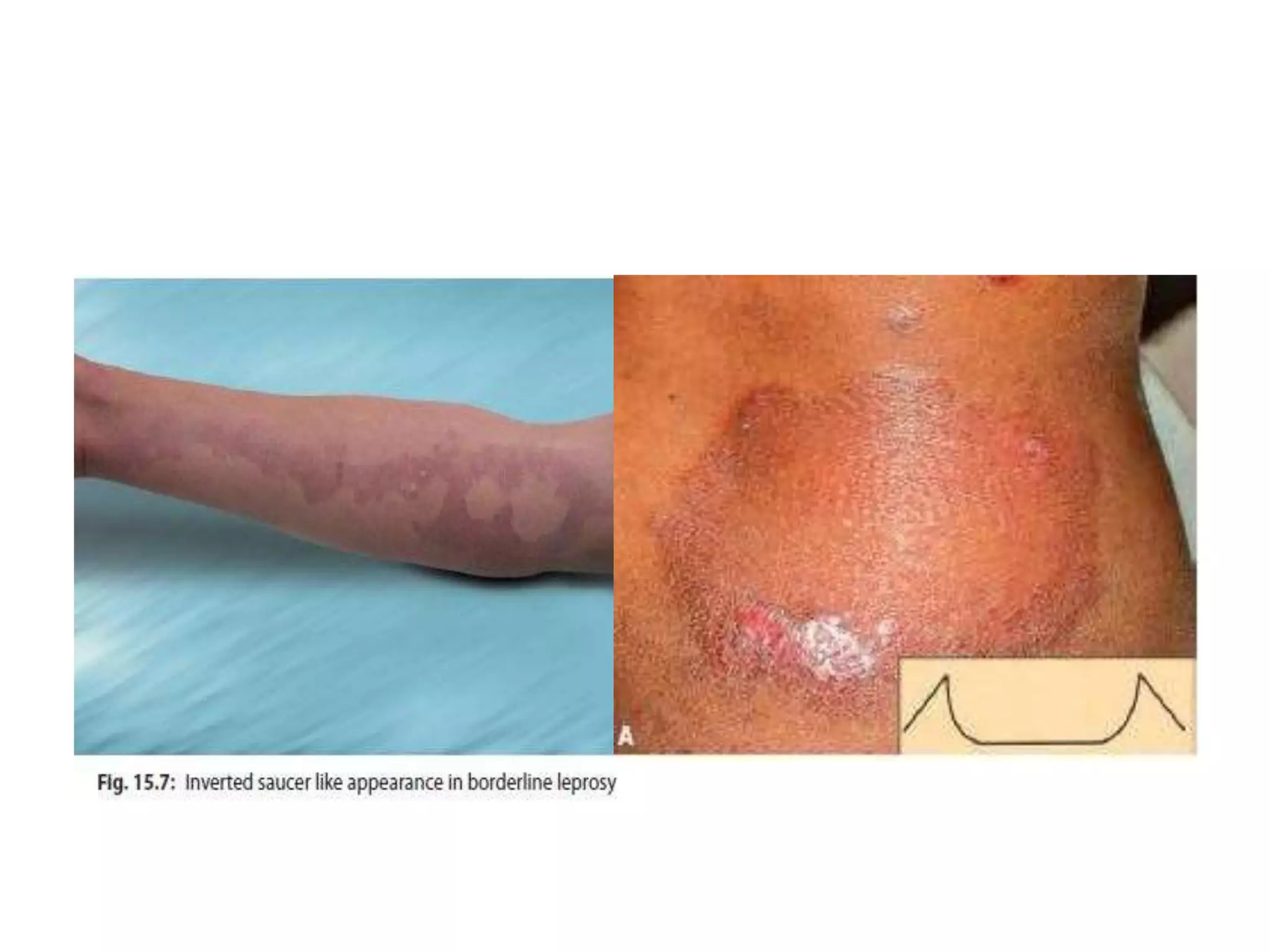 Cutaneous lesions in leprosy | PPTX