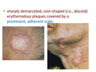 Cutaneous lupus erythematosus | PPTX