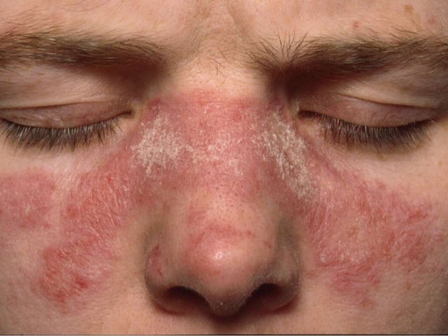 Cutaneous lupus erythematosus