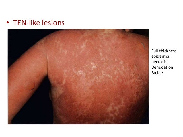 Cutaneous Lupus Erythematosus