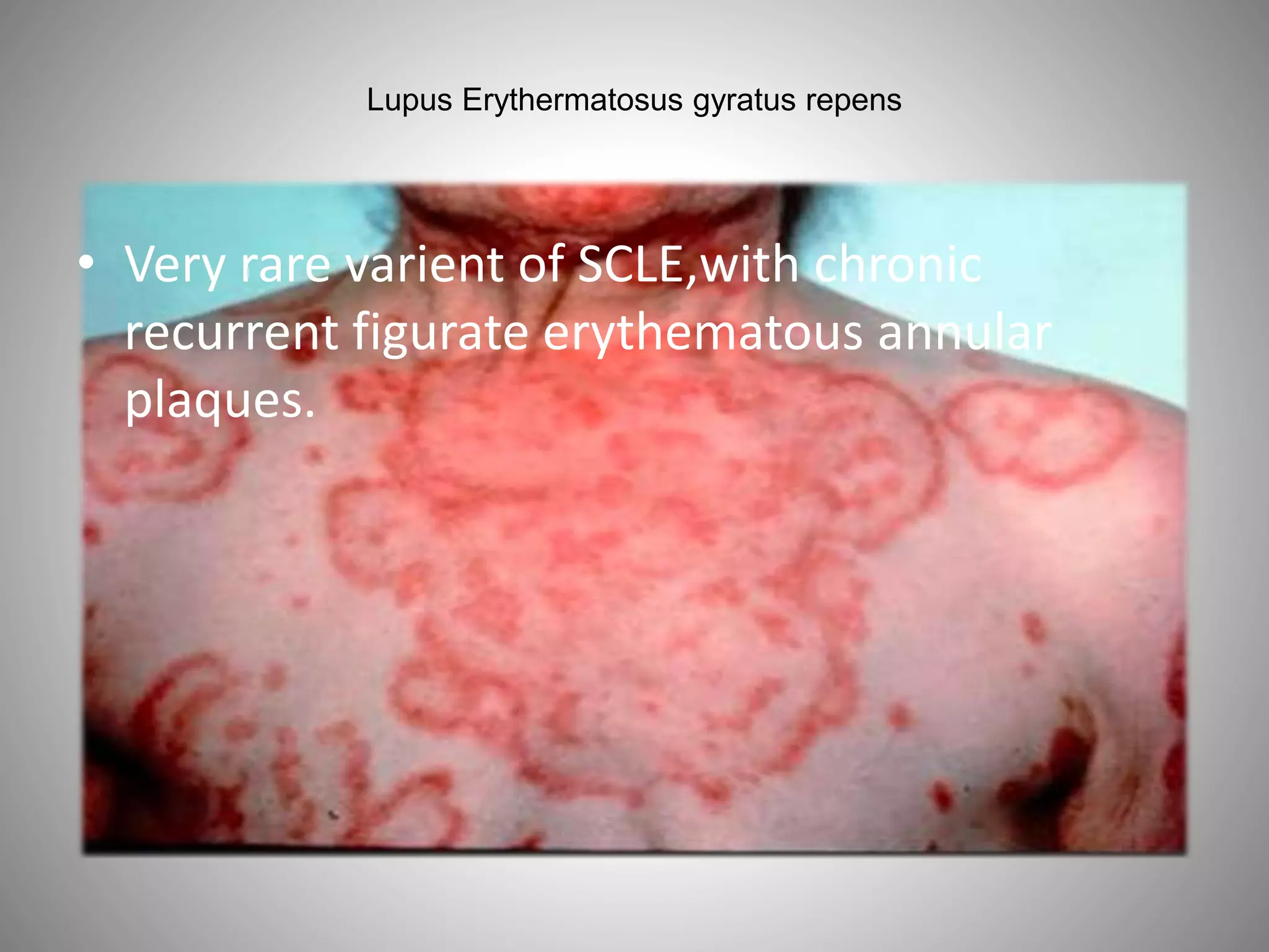 CUTANEOUS LUPUS ERYTHEMATOUS.pptx