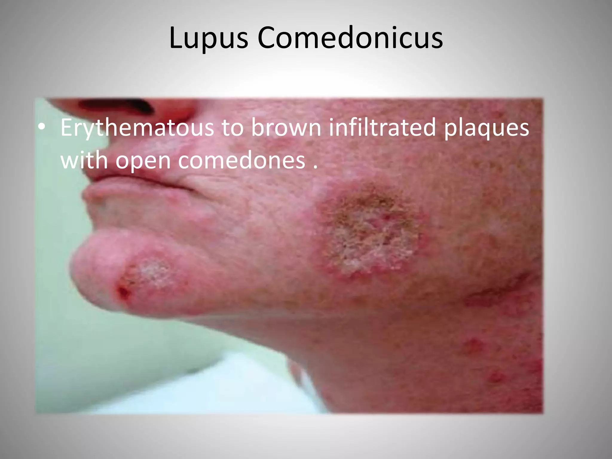 CUTANEOUS LUPUS ERYTHEMATOUS.pptx