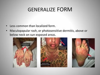 CUTANEOUS LUPUS ERYTHEMATOUS.pptx