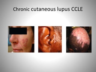 CUTANEOUS LUPUS ERYTHEMATOUS.pptx