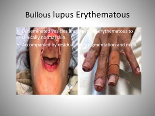 CUTANEOUS LUPUS ERYTHEMATOUS.pptx