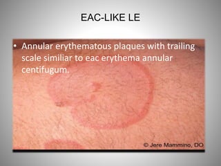 CUTANEOUS LUPUS ERYTHEMATOUS.pptx