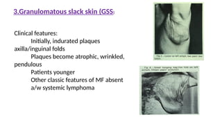 Cutaneous lymphoma.pptx, ppt for pathology pgs | PPTX