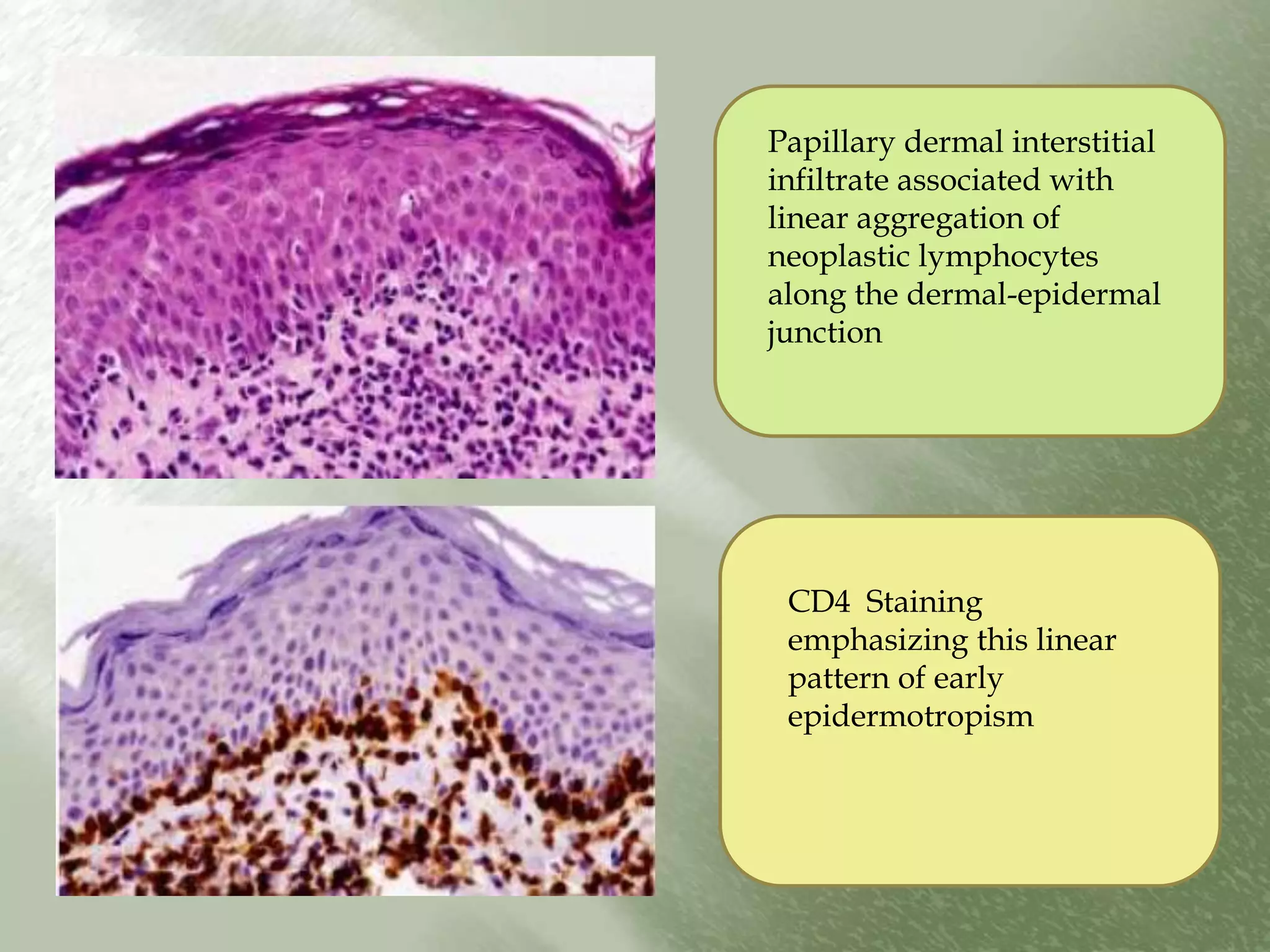 Cutaneous lymphoproliferative disorders | PPTX