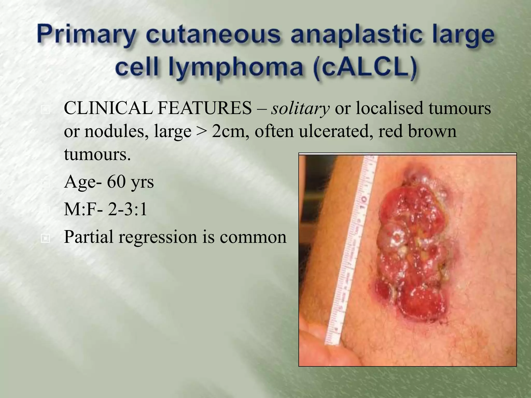 Cutaneous lymphoproliferative disorders | PPTX