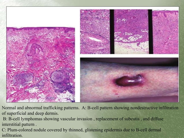 Cutaneous lymphoproliferative disorders | PPTX | Skin and Dermatology ...