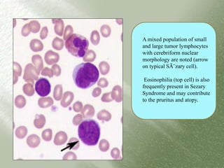 Cerebriform Lymphocytes