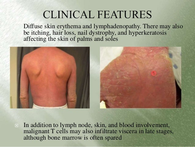 Cutaneous lymphoproliferative disorders