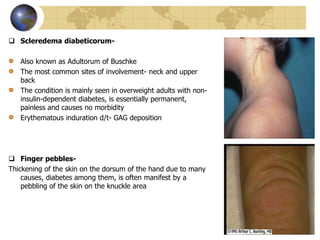 Cutaneous manifeatations in endocrine disorders | PPT