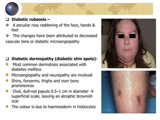 Cutaneous manifeatations in endocrine disorders | PPT