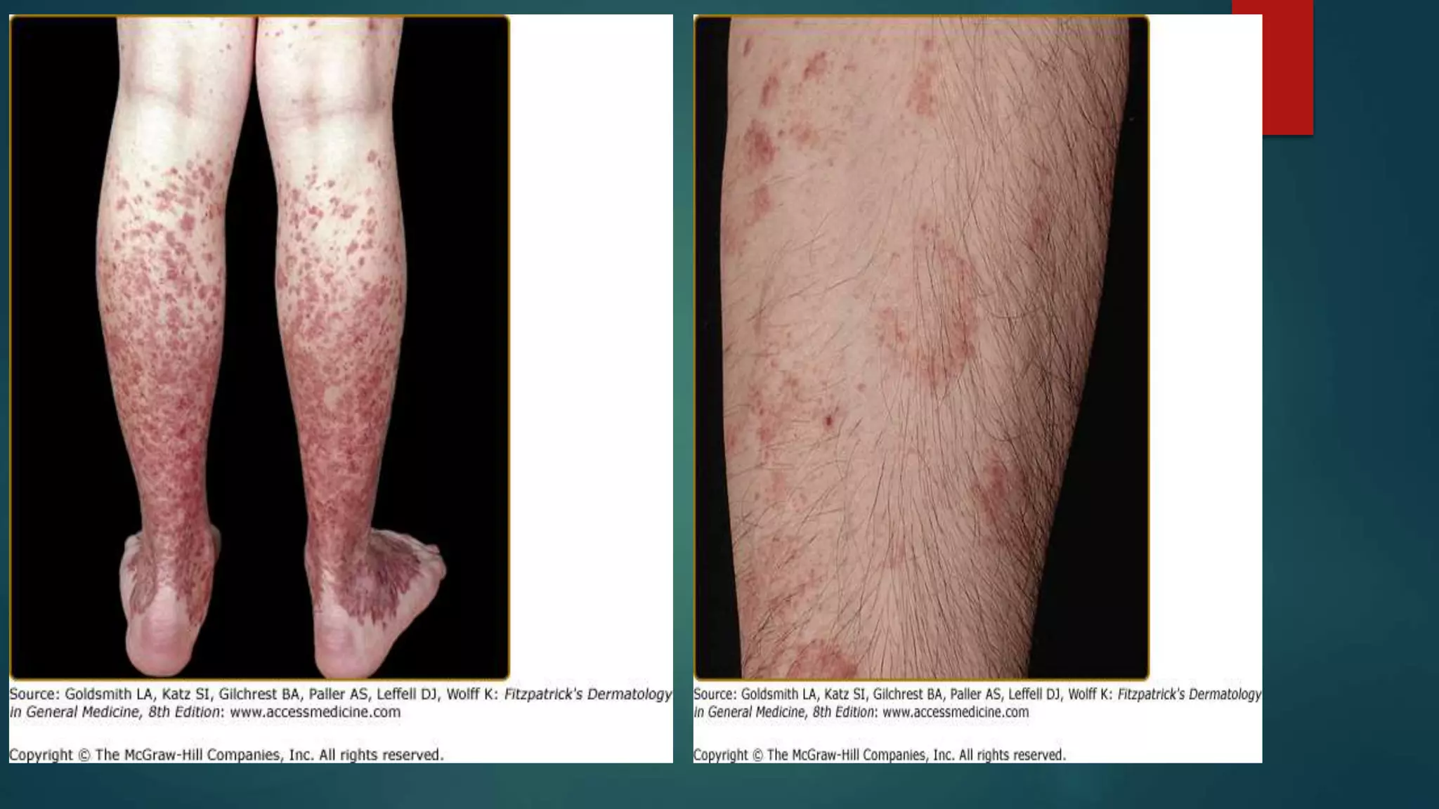 Cutaneous manifestations of diabetes mellitus | PPTX