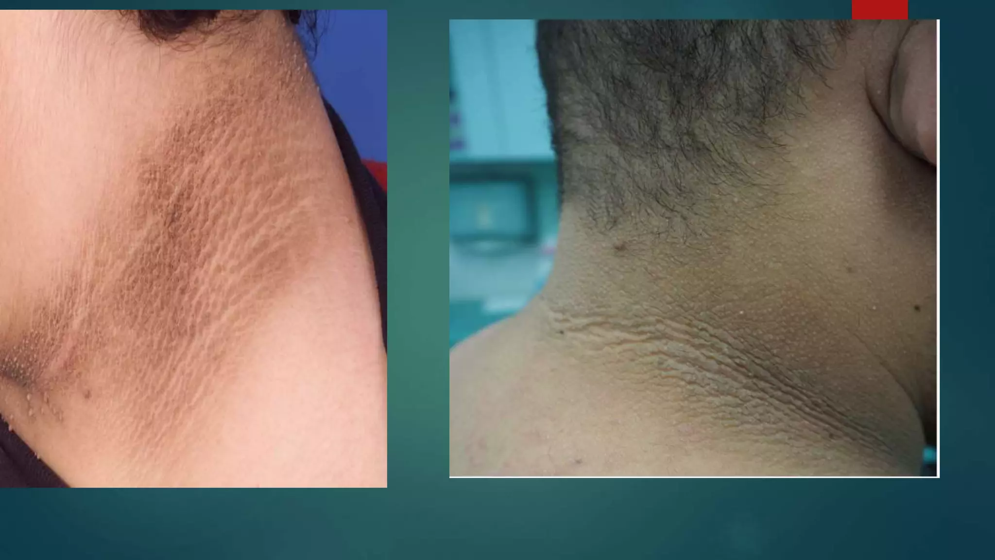 Cutaneous manifestations of diabetes mellitus | PPTX