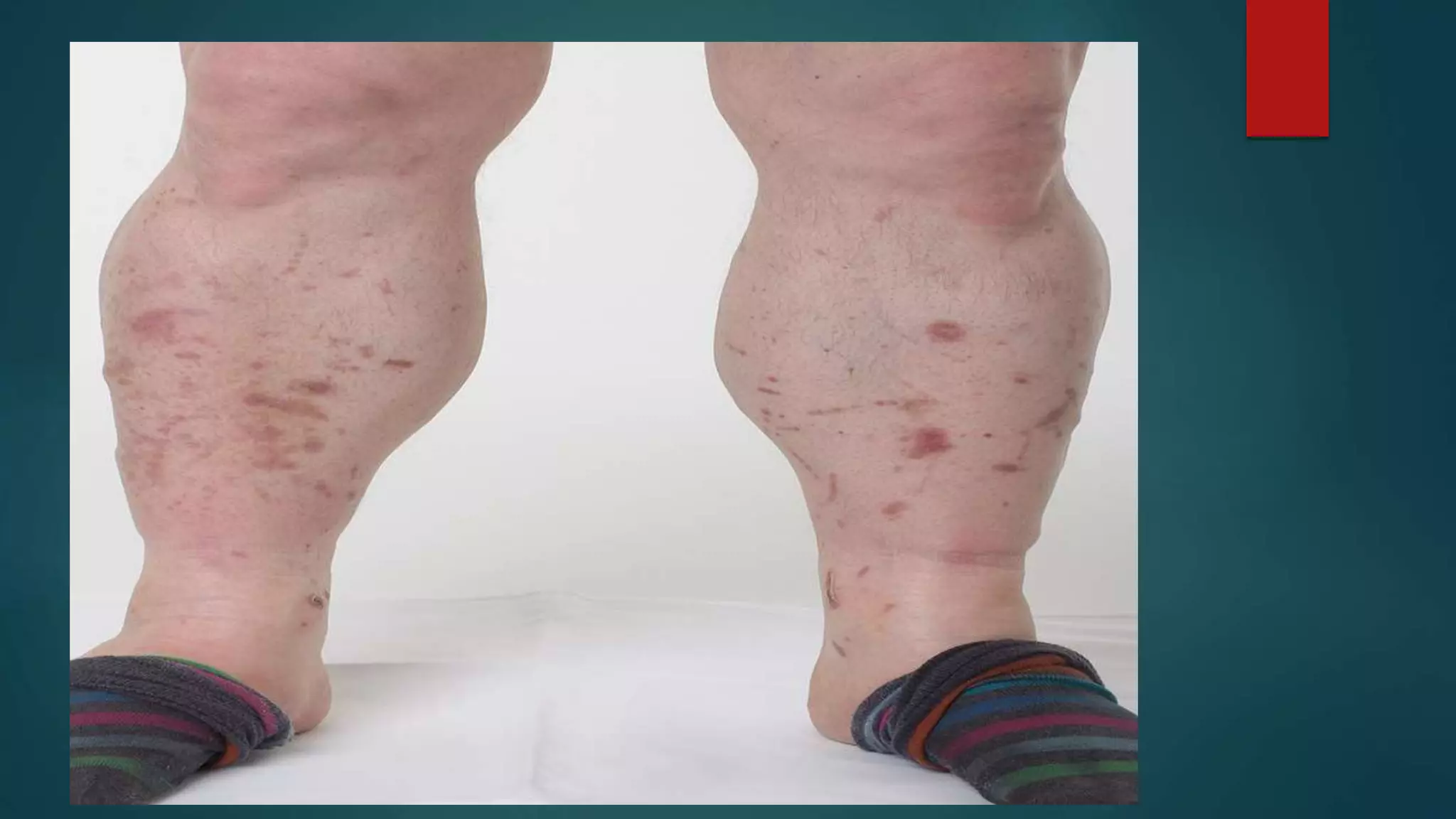 Cutaneous manifestations of diabetes mellitus | PPTX