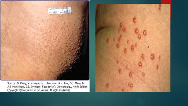 Cutaneous manifestations of diabetes mellitus | PPTX