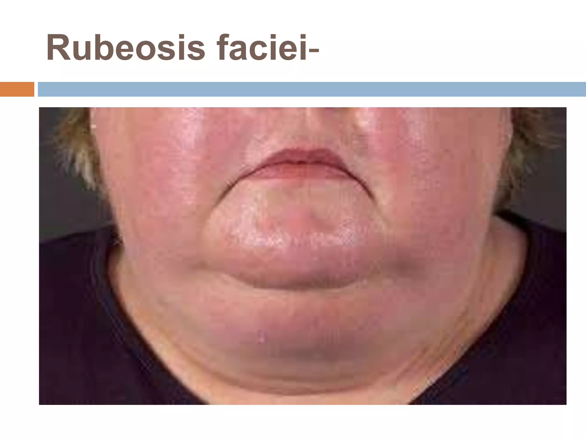 Cutaneous manifestations of endocrine disease | PPTX